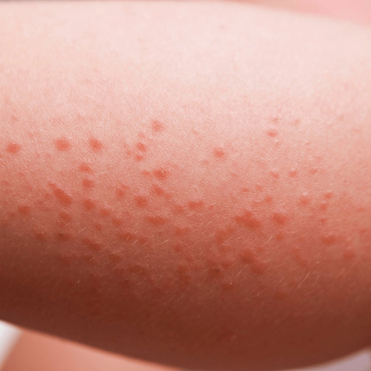 Is It Heat Rash Or Sun Rash and How To Prevent/Treat It.